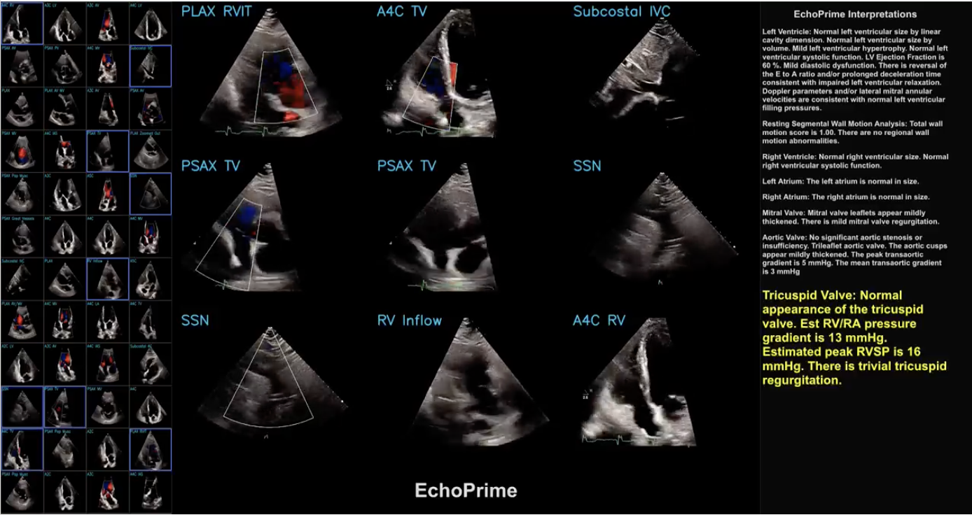 BrainX Community Live! December 2024: Foundation models in Cardiology - Automating ...